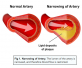 Cardiovascular Disease: Stents and Lifestyle (GCSE Biology) - Study Mind