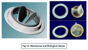 Cardiovascular Disease: Artificial Hearts and Transplants (GCSE Biology ...